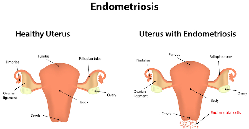5 Facts About Endometriosis & How To Deal With It – SevenPie.com ...